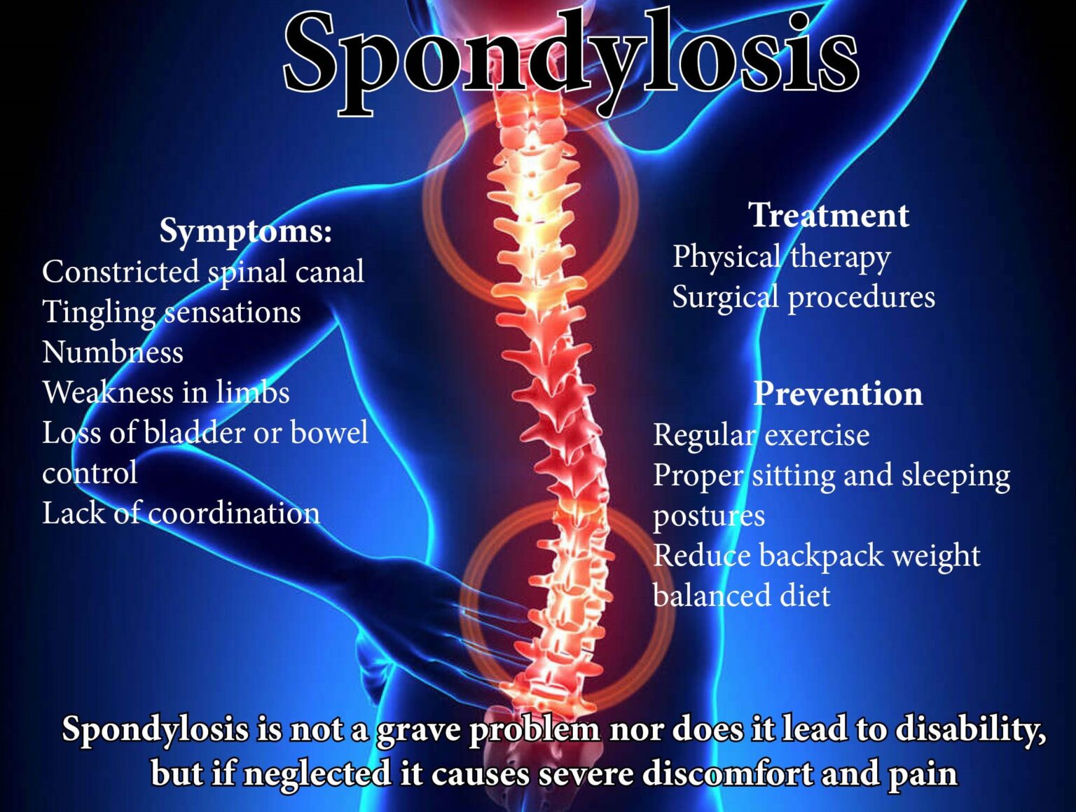 Spondylosis and its Impact on life